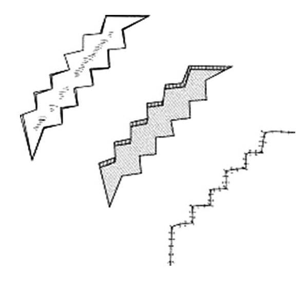 Labiaplasty Cosmetic Surgery With Z-plasty Technique